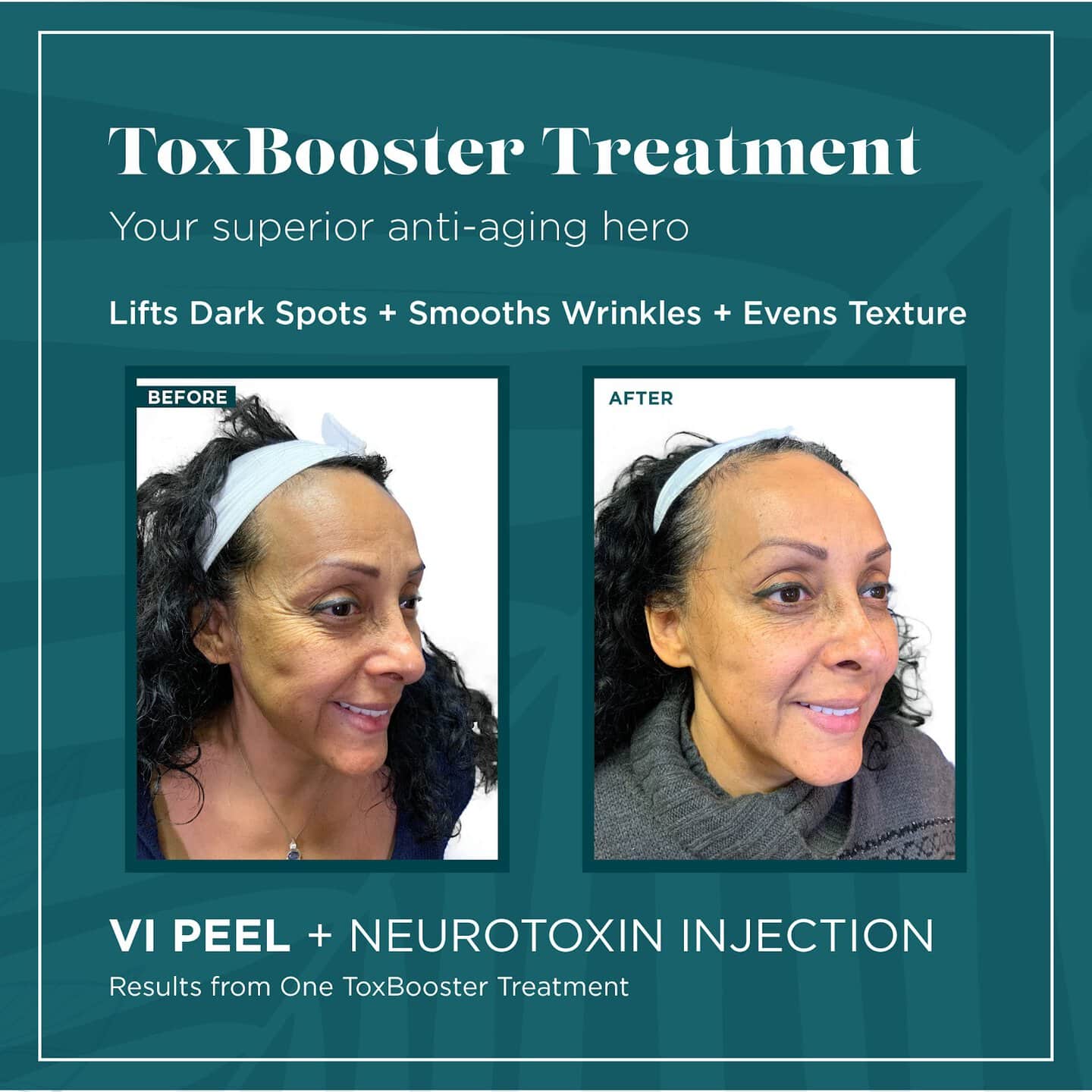 VI Peel Long Island NY - Toxbooster VI Peel Long Island NY